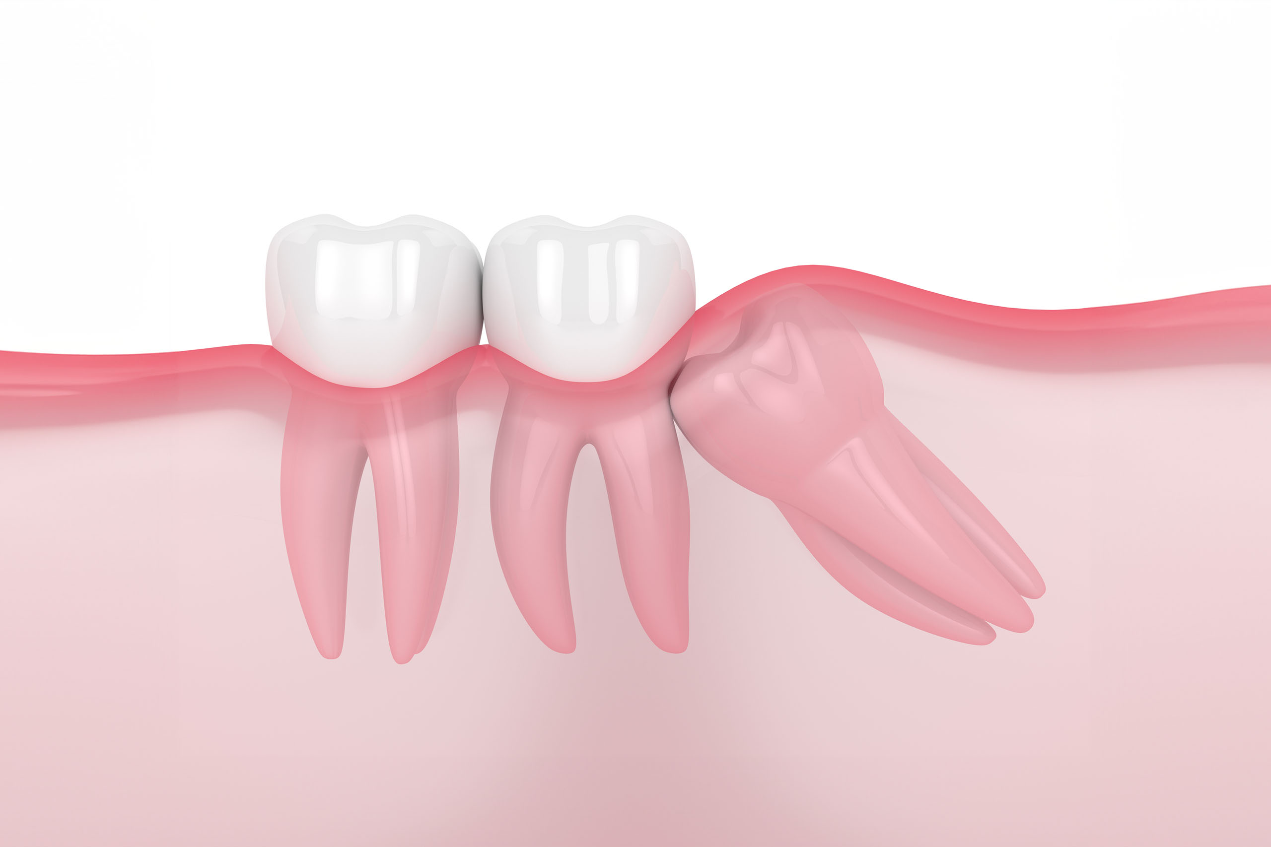 Wisdom Tooth Pain - Placerville Emergency Dentist